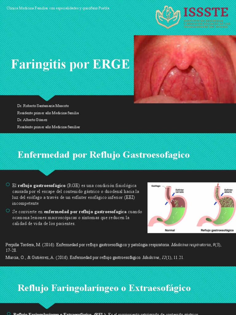 Faringitis Por ERGE | PDF | La enfermedad por reflujo gastroesofágico | Tos
