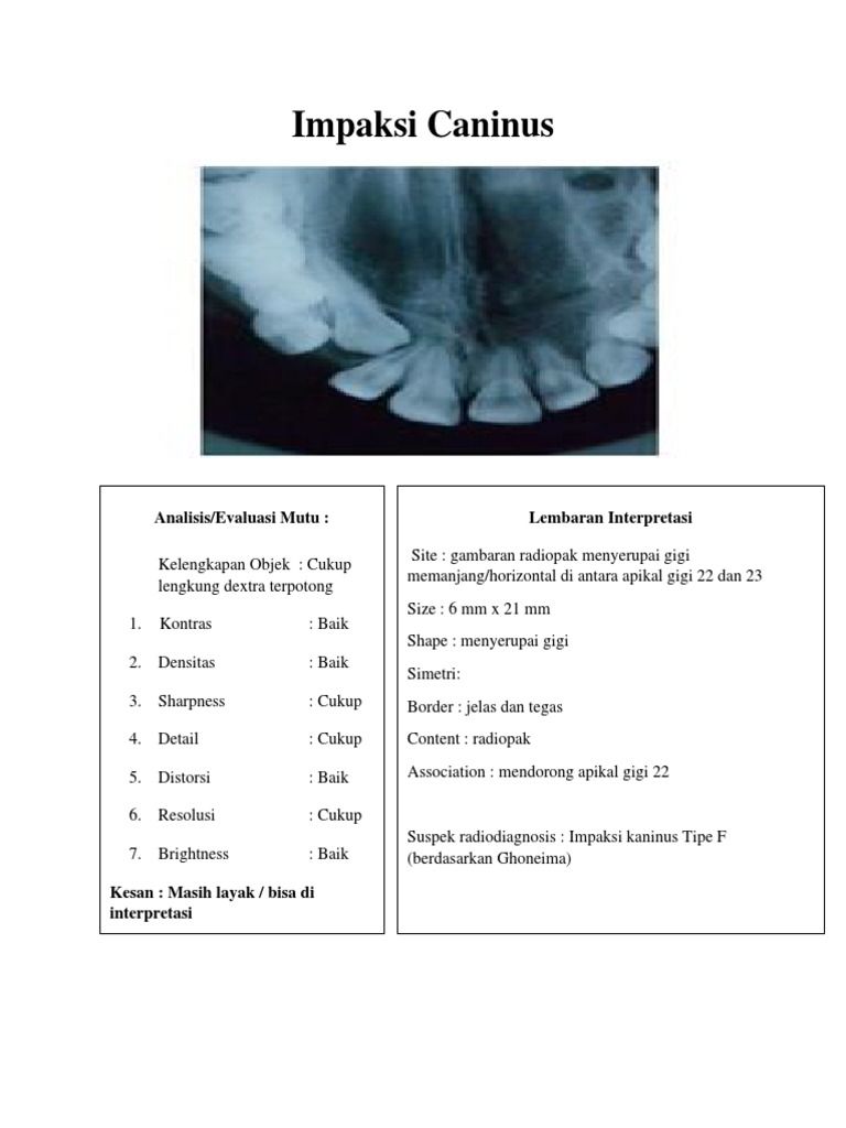 Impaksi Caninus Beserta KLAS Nya | PDF