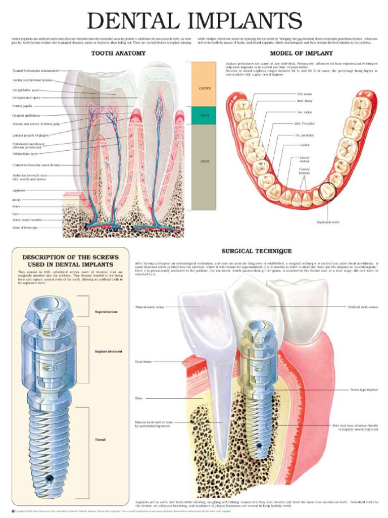 Dental Implants e Chart | PDF | Dental Implant | Dentistry