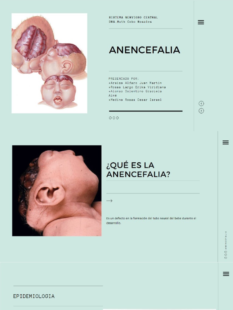 Equipo 1 Anencefalia | PDF