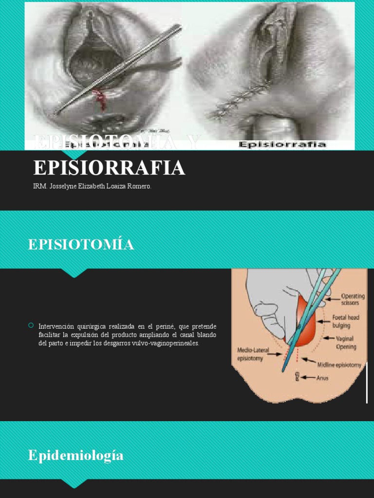 Episiotomía y Episiorrafia | PDF | Parto | Especialidades Medicas