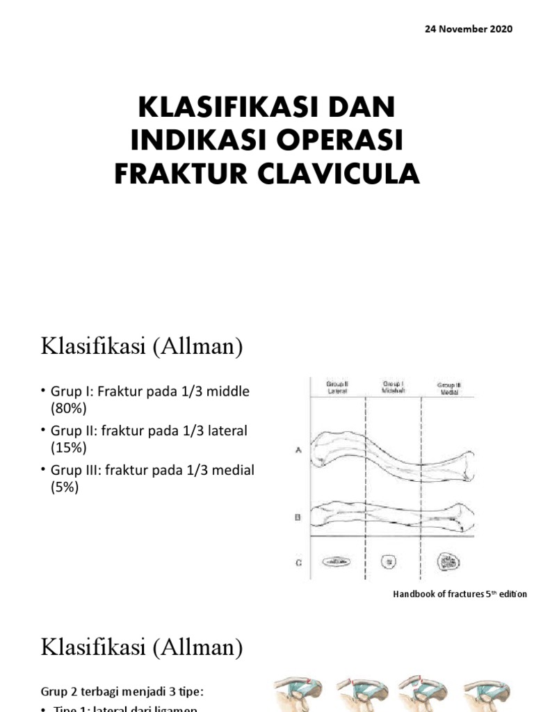 Klasifikasi Dan Indikasi Operasi Fraktur Clavicula (Dr. Andre) | PDF