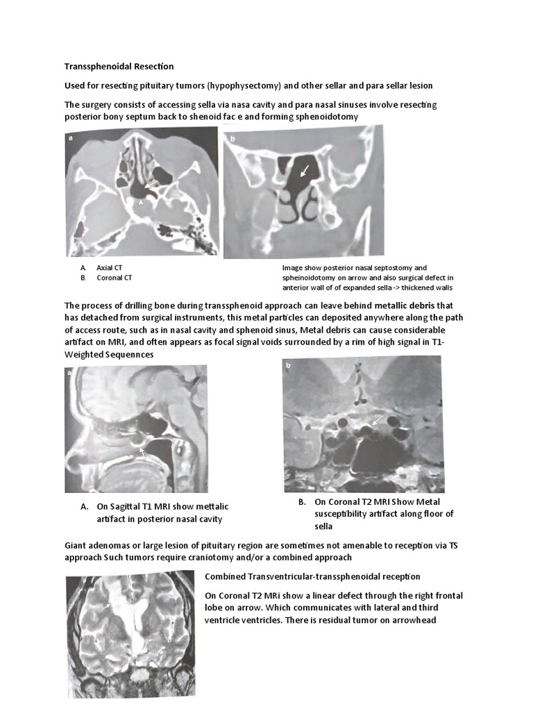 Transsphenoidal Resection | PDF | Magnetic Resonance Imaging | Medical ...
