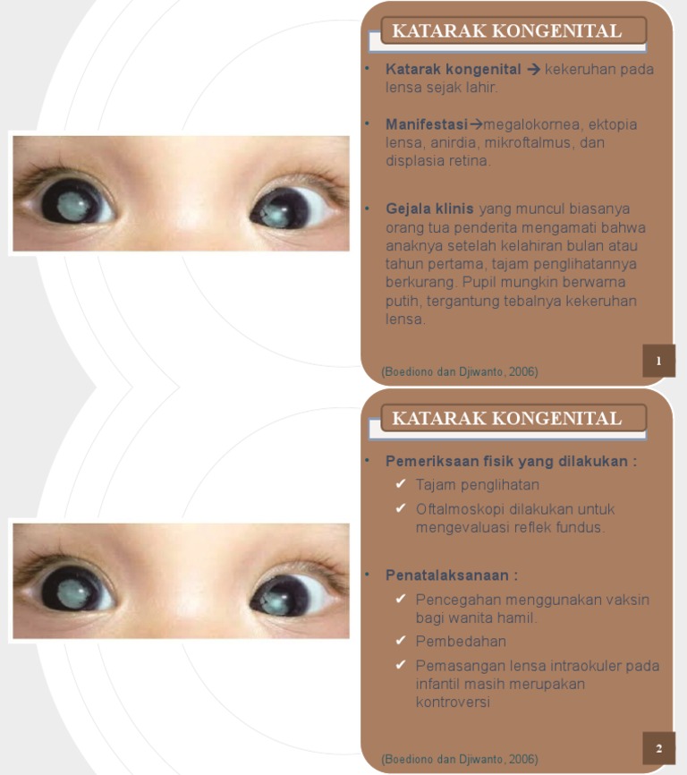 Katarak Kongenital | PDF