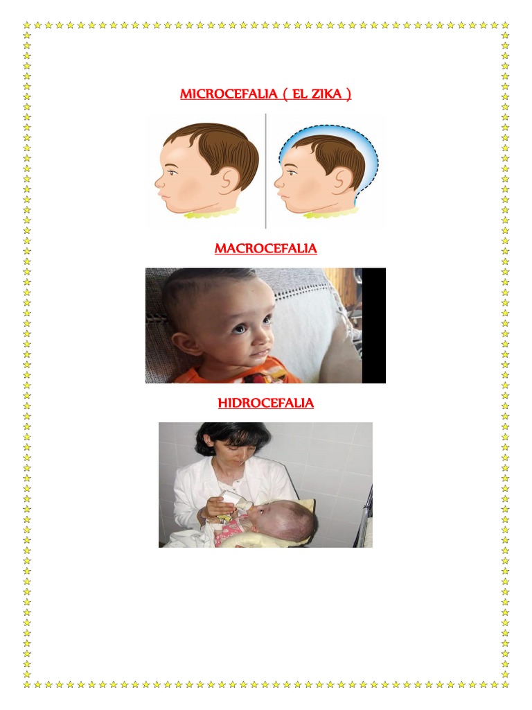 Microcefalia Macrocefalia e Hidrocefalia | PDF | Ciencias de la Salud | Epidemiología