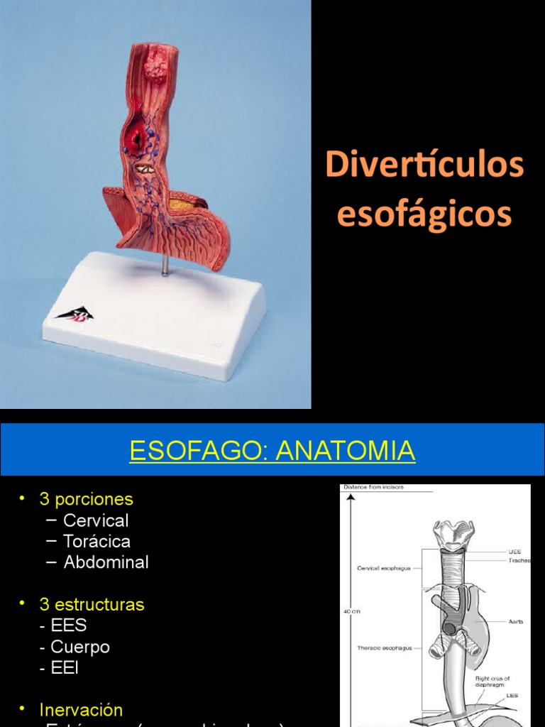 A-Clase 1.9 Diverticulos Esofagicos | PDF | Esófago | Enfermedades y ...