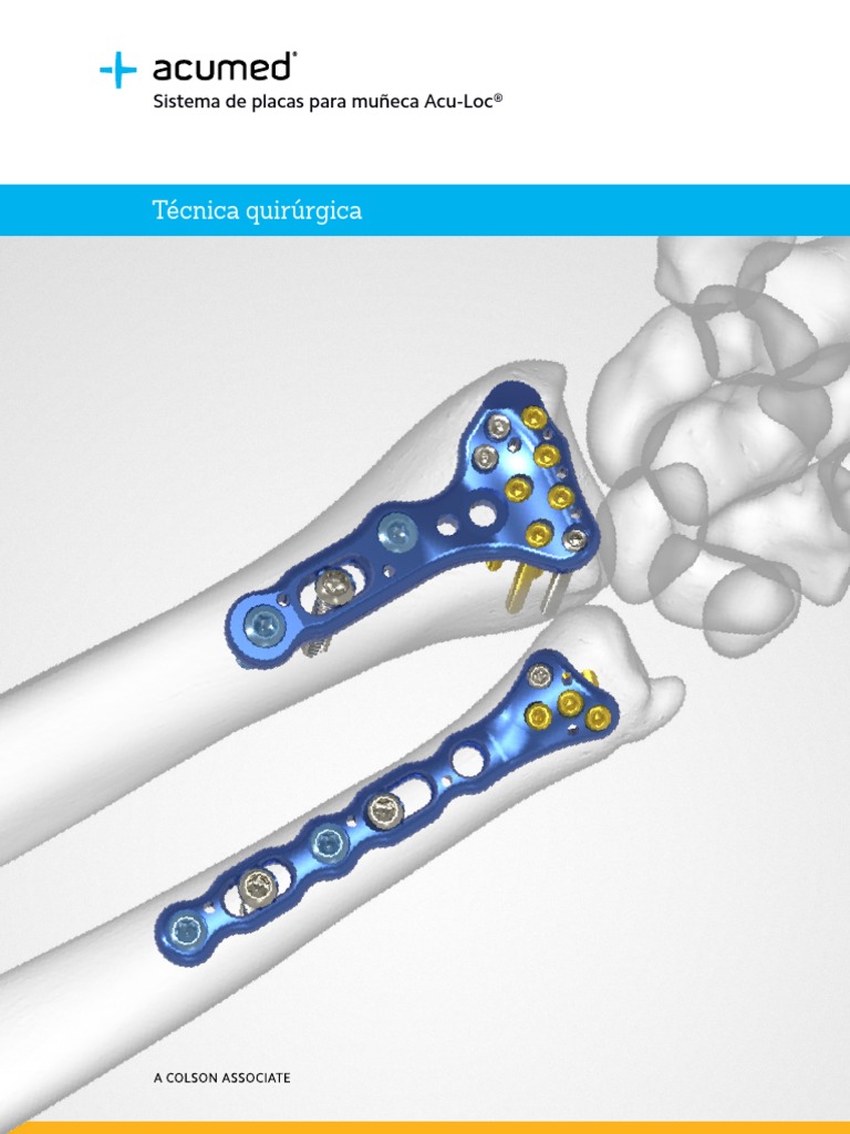 Acumed Surgical Technique ES Acu Loc Wrist Plating System ESHNW00 01 A ...