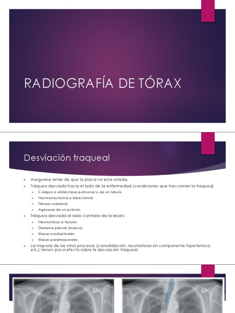 RX de Torax 2 | PDF | Pulmón | Medicina CLINICA