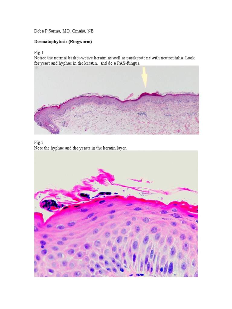 Dermatophytosis (Ringworm) | PDF