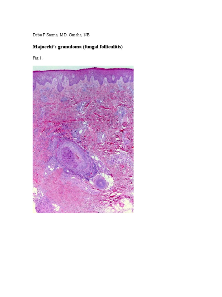 Majocchi's Granuloma (Deep Fungal Folliculitis) | PDF