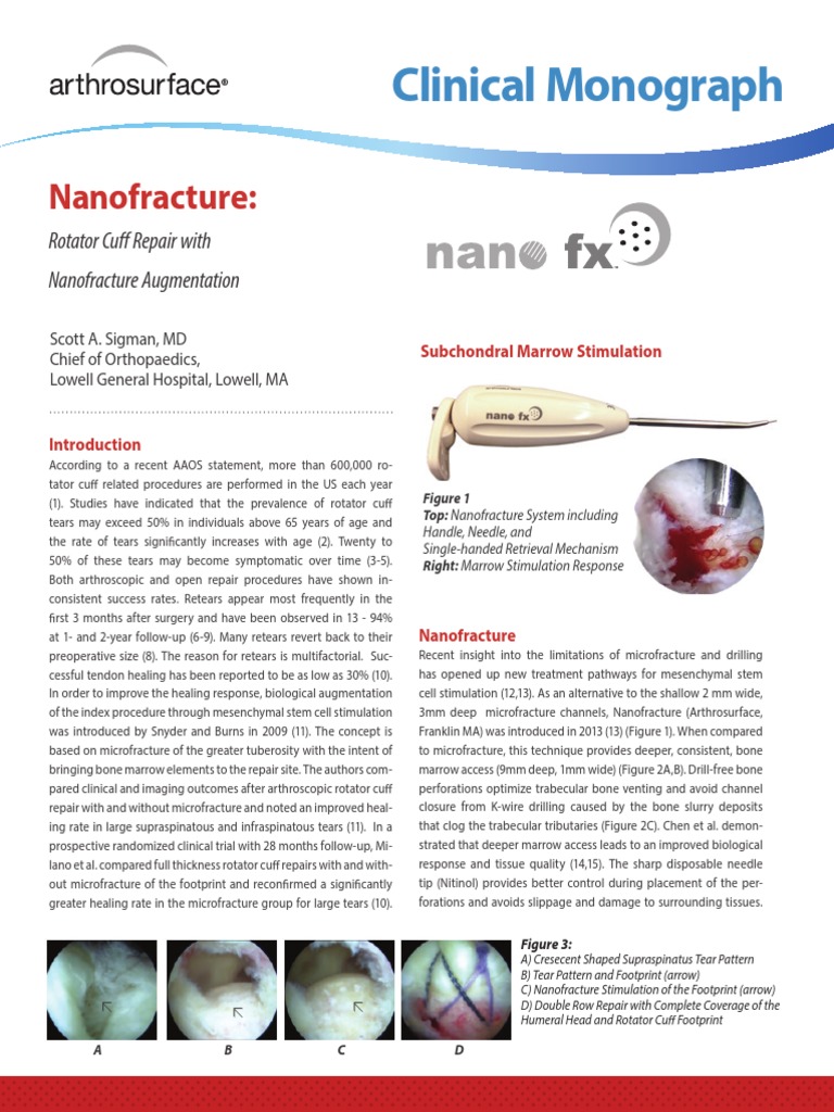 Clinical Monograph: Nanofracture | PDF | Shoulder | Bone