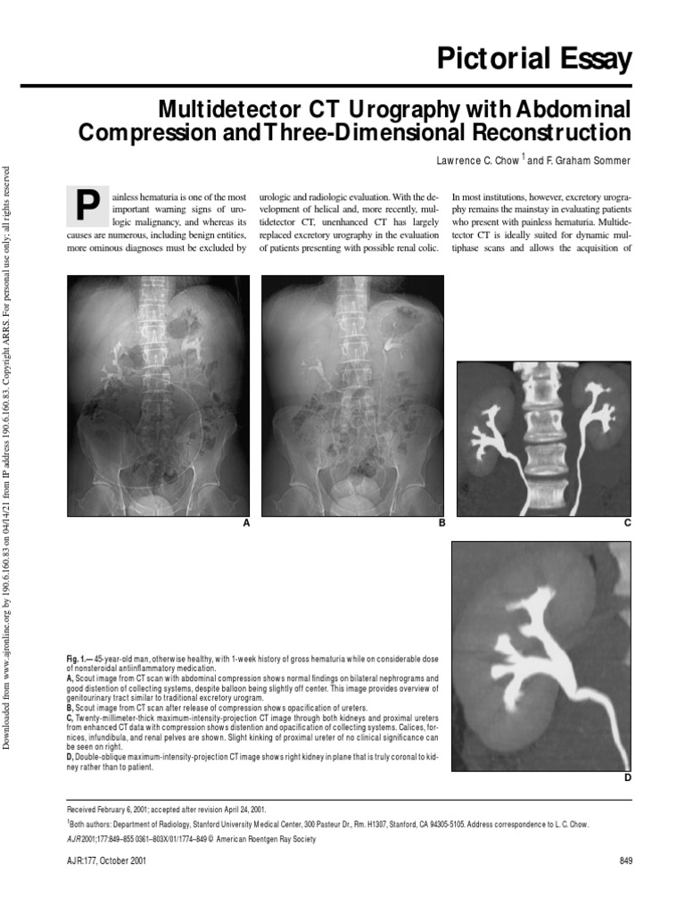 Pictorial Essay: Multidetector CT Urography With Abdominal Compression ...