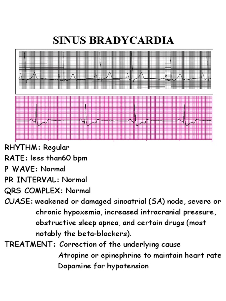 Ecg Notes | PDF | Electrophysiology | Cardiac Arrhythmia