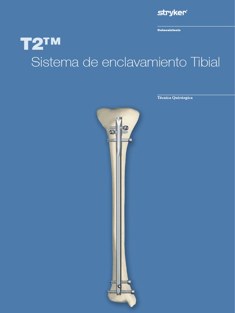 T2 Tibia | PDF | Tornillo | Rodilla