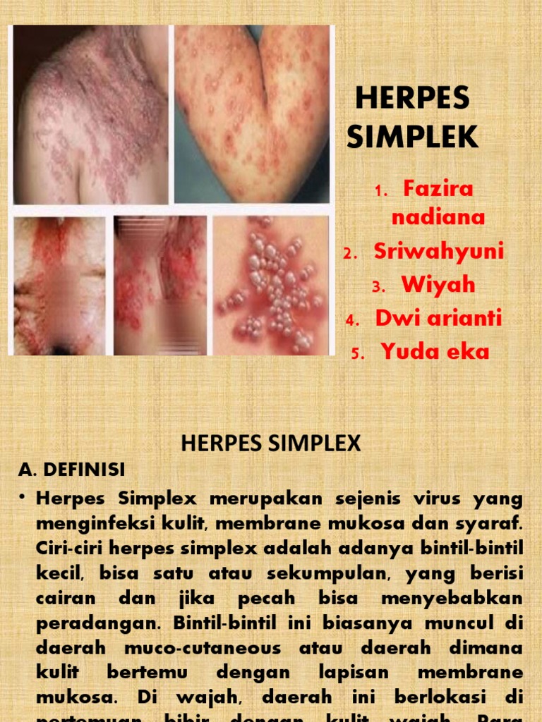 Herpes Simplek Pdf