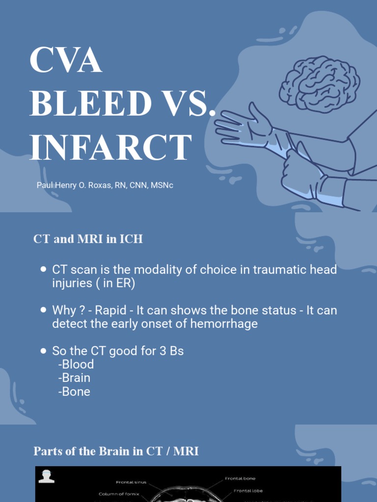 CVA Bleed vs. Infarct | PDF | Stroke | Human Diseases And Disorders