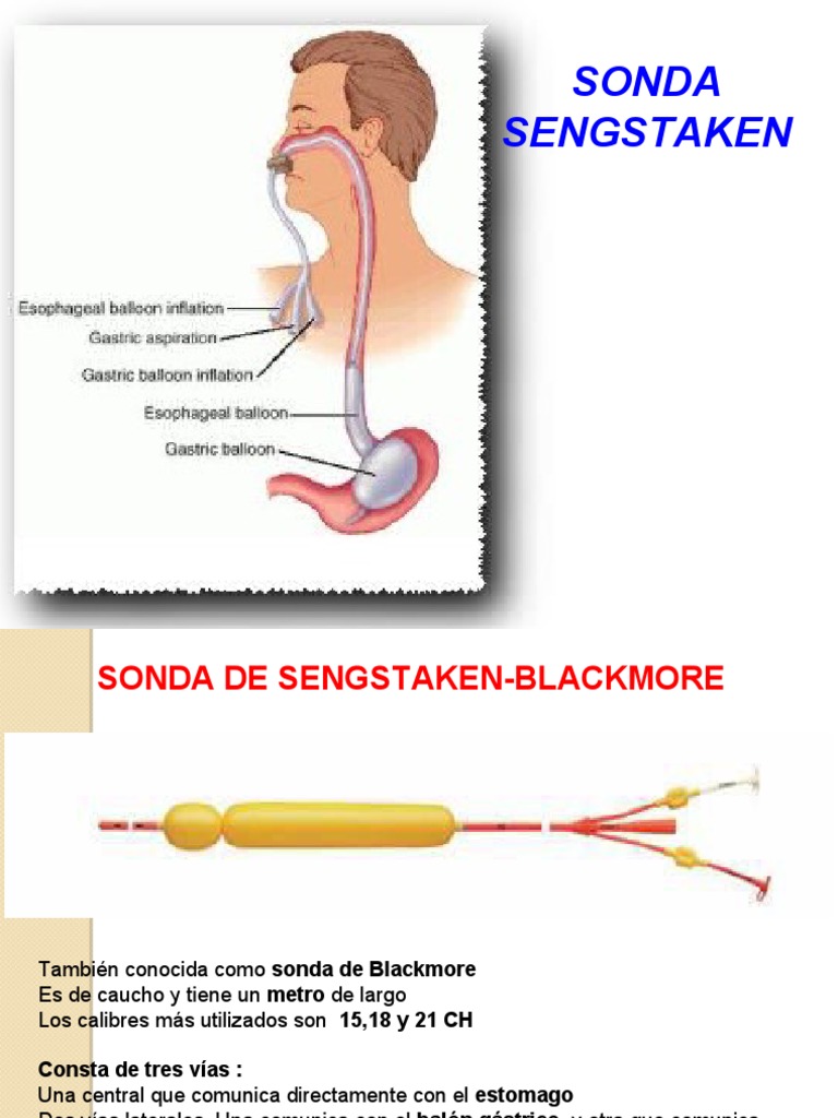 Manejo de la sonda de Sengstaken-Blackmore para el control de ...