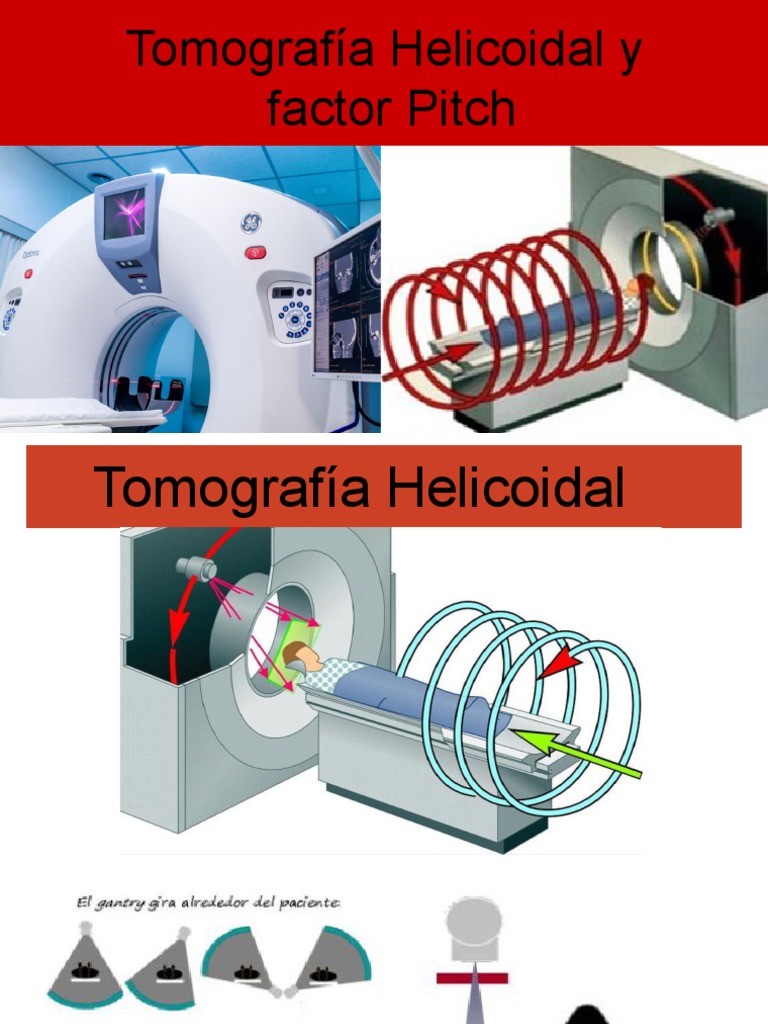 Pitch y TC Helicoidal | PDF | Ct Scan