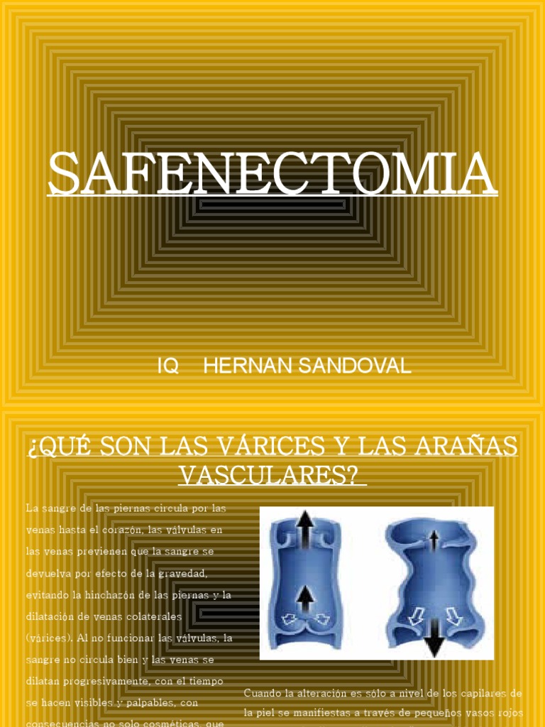 SAFENECTOMIA | PDF | Venas varicosas | Edema