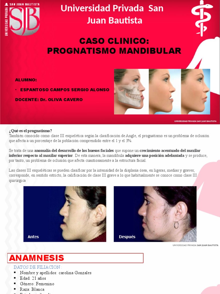 CC de Prognatismo Mandibular Didacticas | PDF | Especialidades Medicas ...