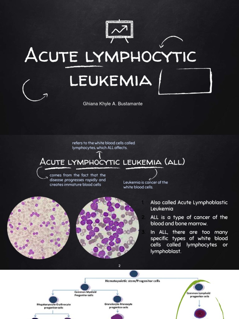 Acute Lymphocytic Leukemia | PDF | Leukemia | Lymphocyte