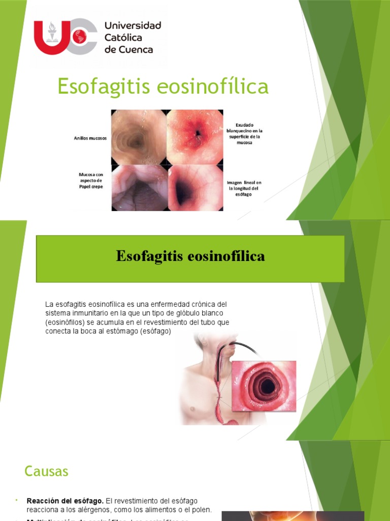 Esofagitis Eosinofílica | PDF | Alergia | Esófago