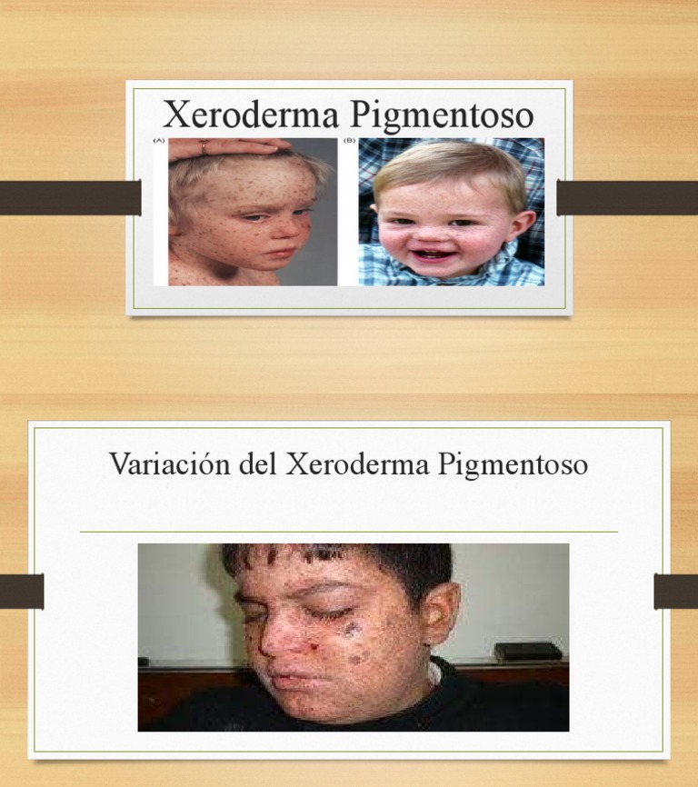 Xeroderma Pigmentoso Powerpoint | PDF