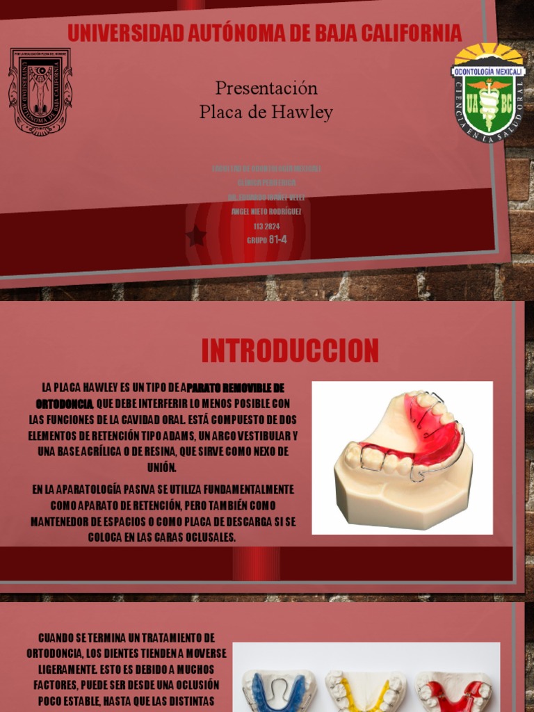 Placa Hawley | PDF