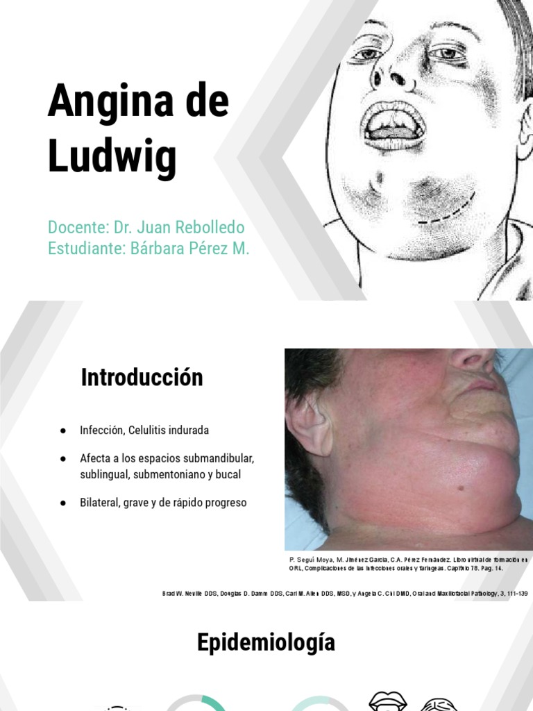 Angina de Ludwig: Epidemiología y Tratamiento | PDF | Cuidado de la ...