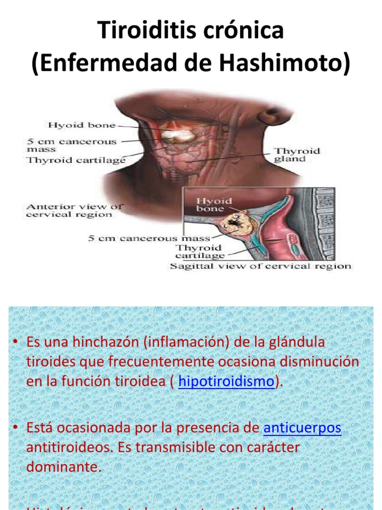 Tiroiditis Crónica (Enfermedad de Hashimoto) Jack | PDF | Tiroides ...