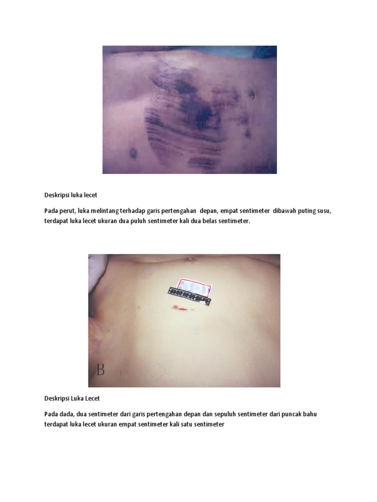 Deskripsi Luka Lecet di Perut dan Dada | PDF | Kesehatan Holistik