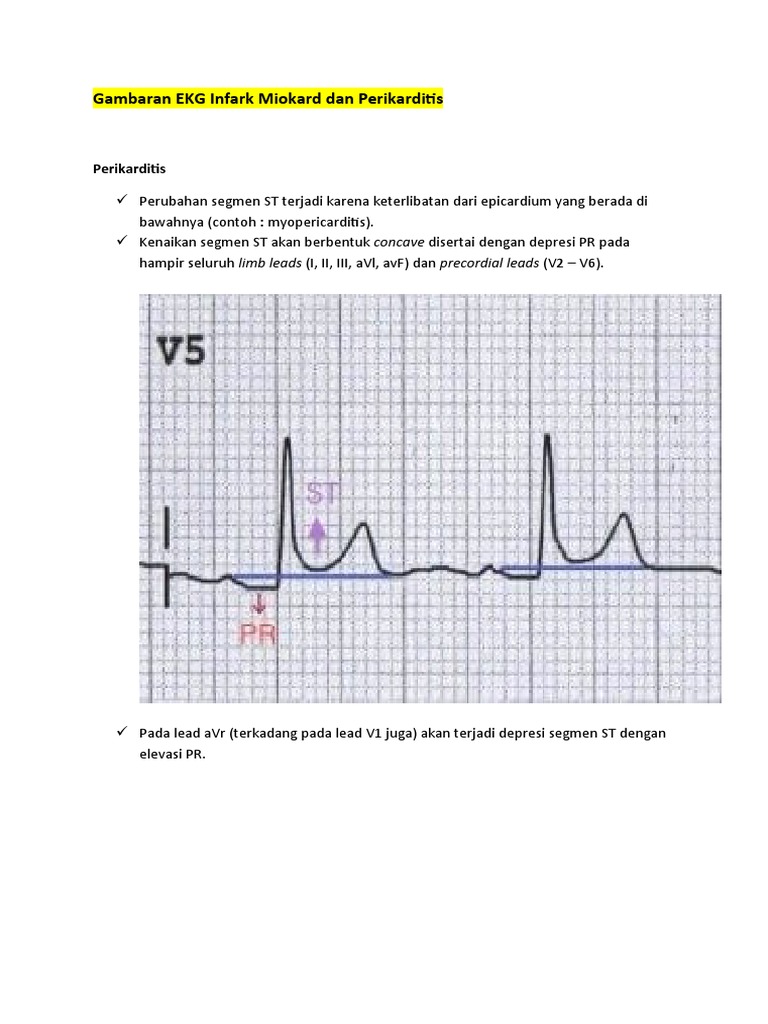 Gambaran EKG Infark Miokard Dan Perikarditis | PDF