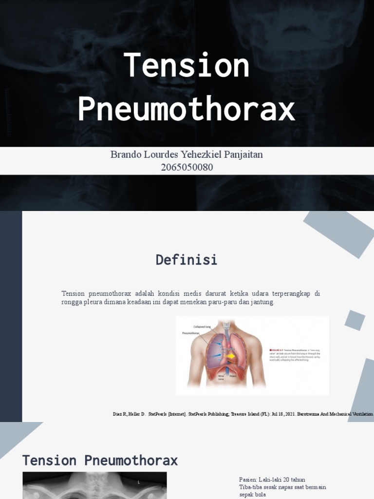 Tension Pneumothorax | PDF
