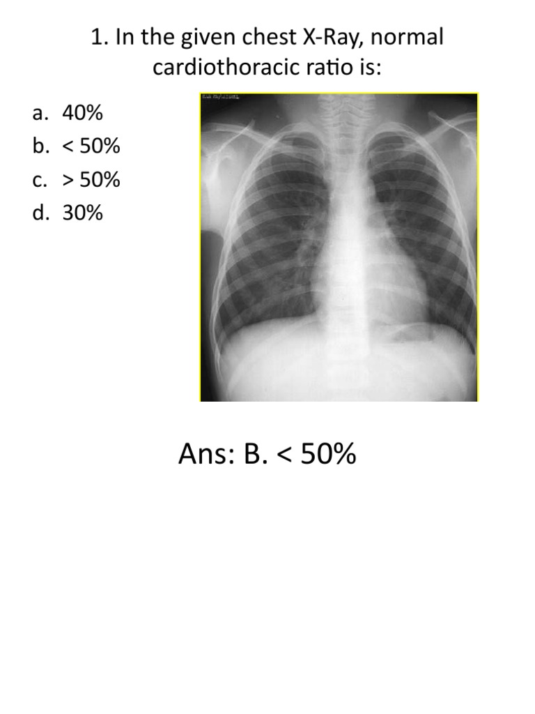 in The Given Chest X-Ray, Normal Cardiothoracic Ratio Is | Download ...