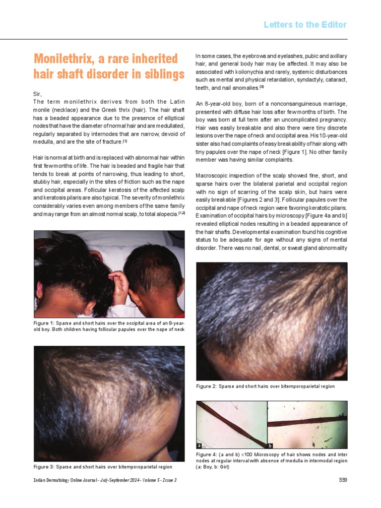 Monilethrix, A Rare Inherited Hair Shaft Disorder in Siblings | PDF ...