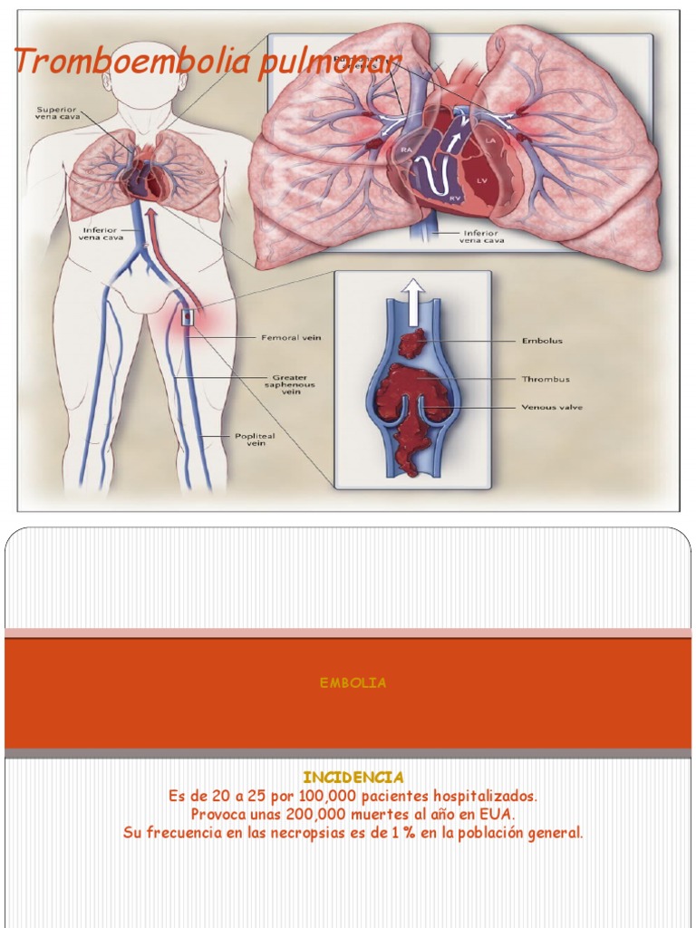 Tromboembolia Pulmonar Tvp Rfm Medicina Interna 2 | Especialidades ...