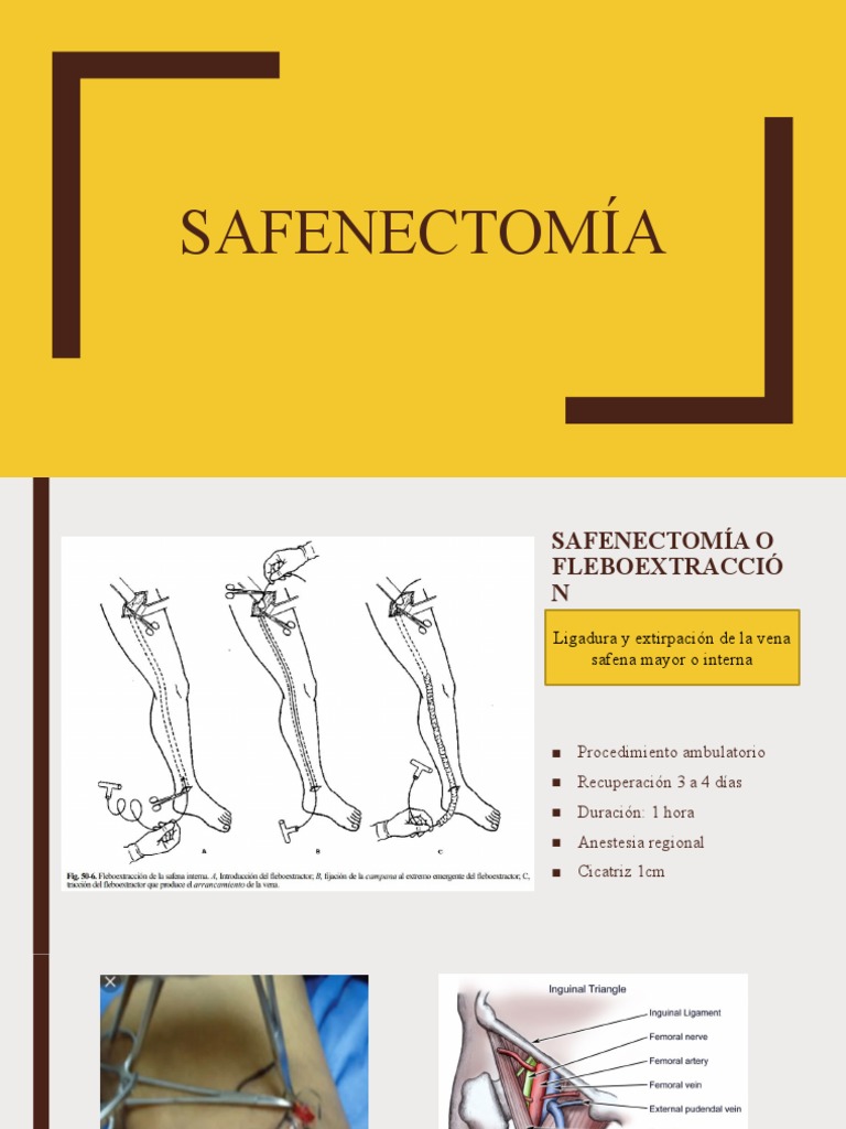 SAFENECTOMÍA | PDF