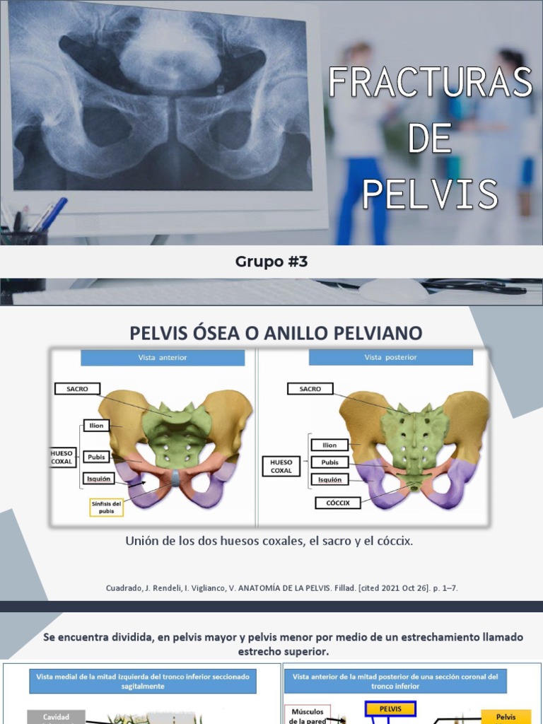 Fracturas de Pelvis Presentación Completa | PDF | Pelvis | Sistema ...