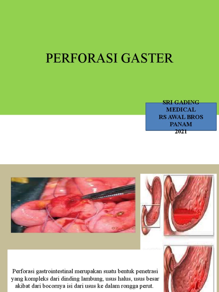 Perforasi Gastrik | PDF
