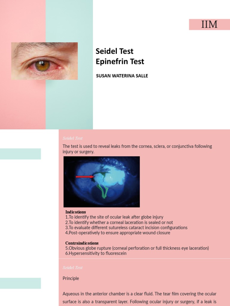 Seidel Test Dan Epinefrin Test | PDF | Cornea | Human Eye