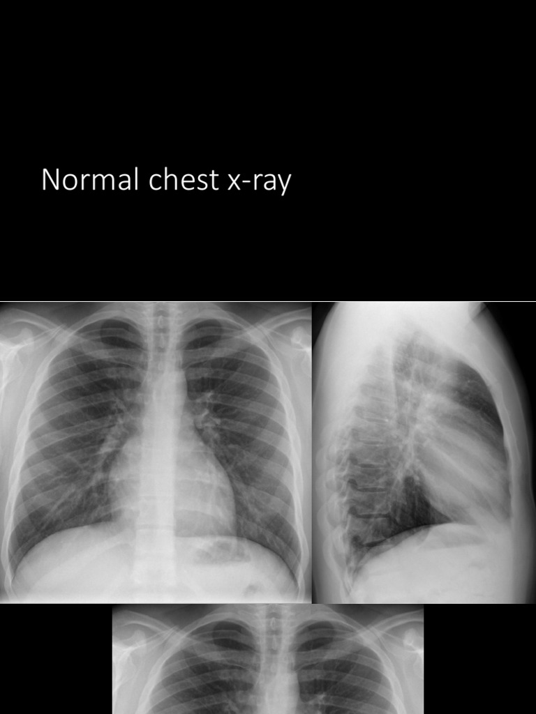Contoh Kasus X-RAY THORAX | PDF