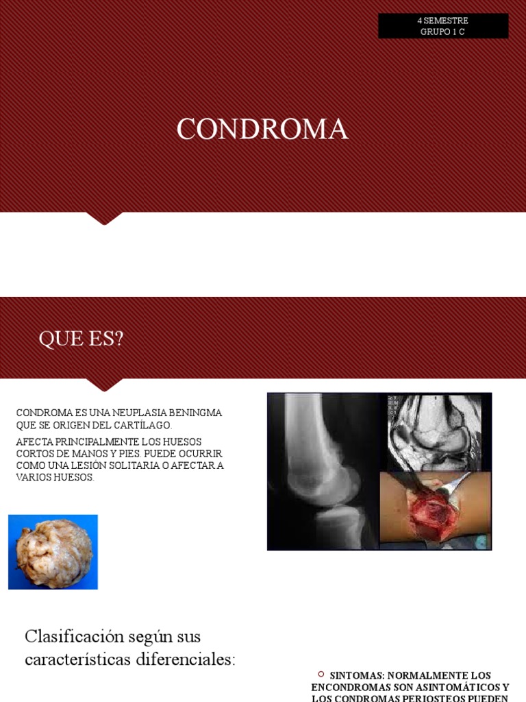CONDROMA | PDF | Hueso | Cartílago