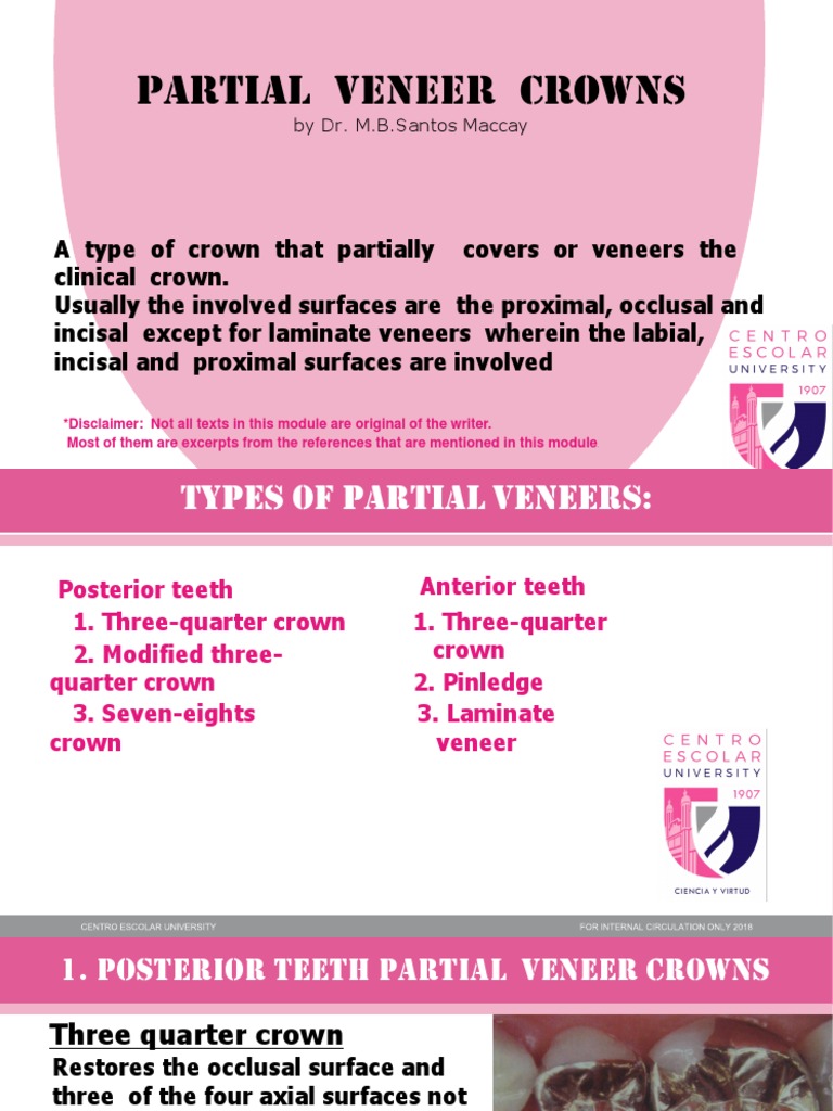 Partial Veneer Crowns: by Dr. M.B.Santos Maccay | PDF | Tooth Enamel ...