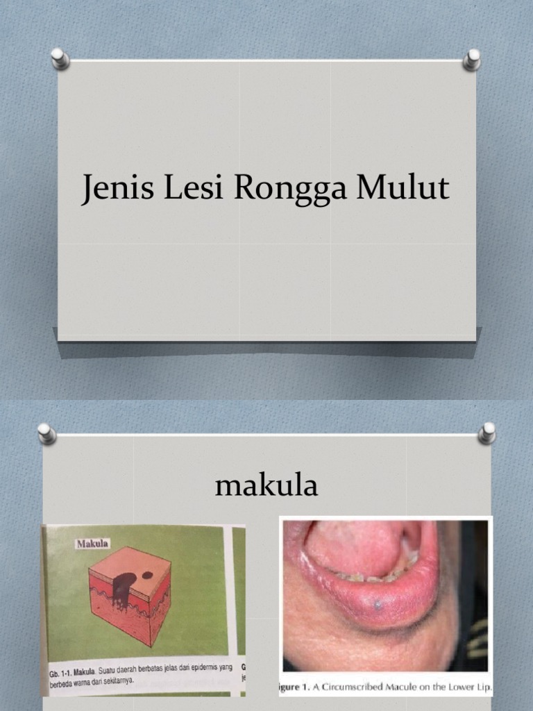 Jenis Lesi Rongga Mulut | PDF