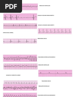 Tipos de Ritmos Cardíacos y Bloqueos AV | PDF