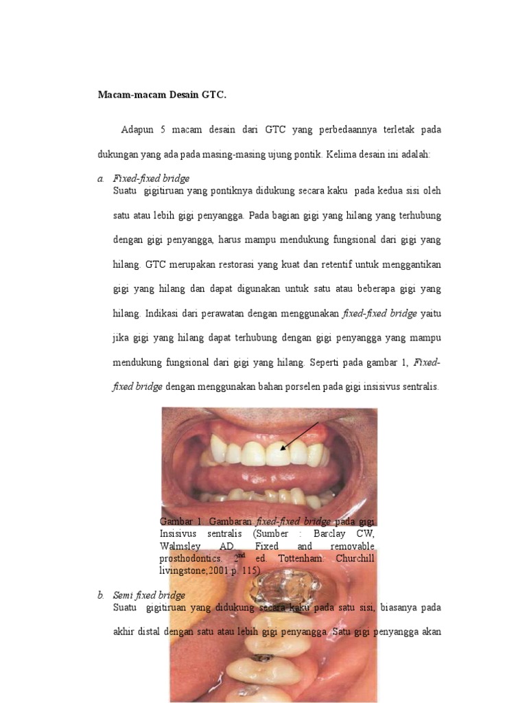 Macam Macam Desain GTC A Fixed Fixed Bridge PDF Free | PDF