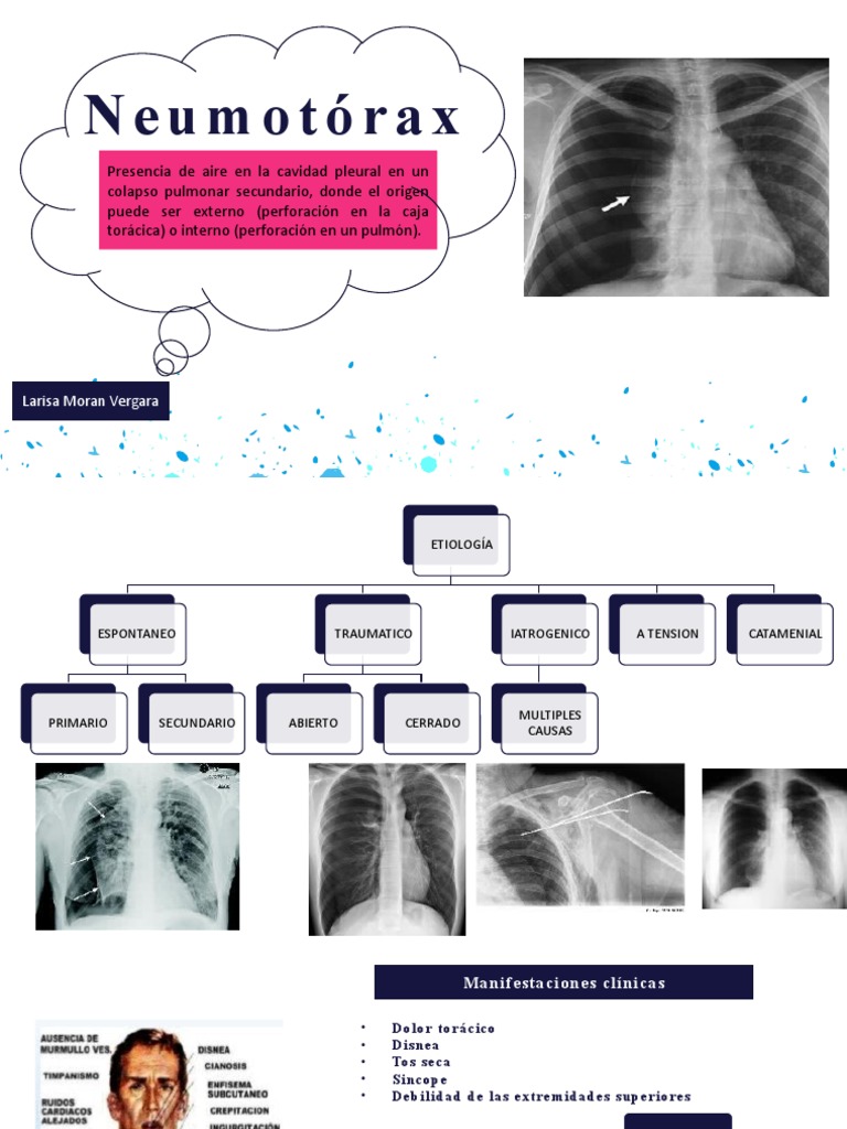 Neumotórax: manifestaciones clínicas, diagnóstico y tratamiento | PDF ...