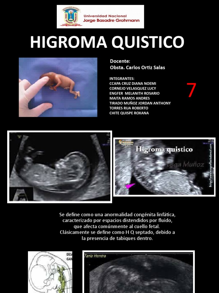 Higroma Quistico. | PDF | Ciencias de la Salud | Especialidades Medicas