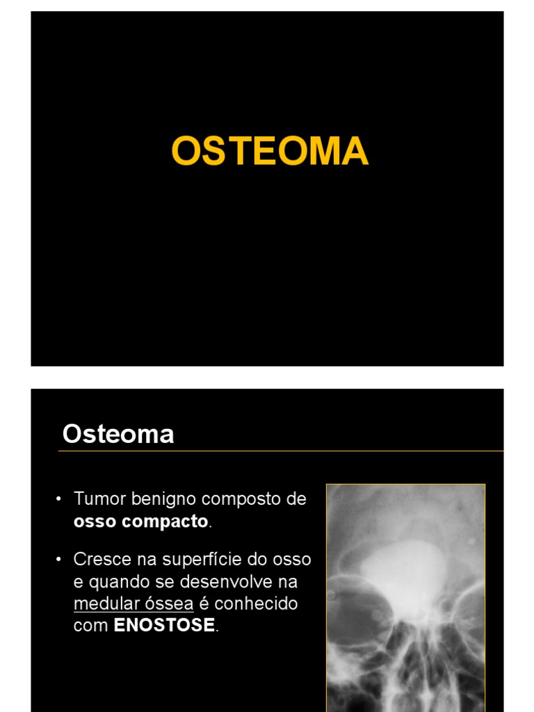 2) Osteoma | PDF