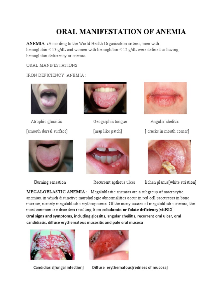 Oral Manifestation of Anemia 1 | PDF | Anemia | Medical Specialties